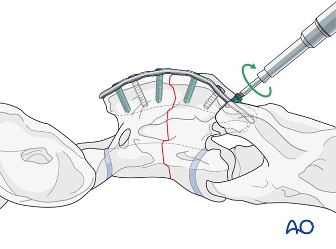 Plate fixation (dorsally) for C2 (Axis) body fractures