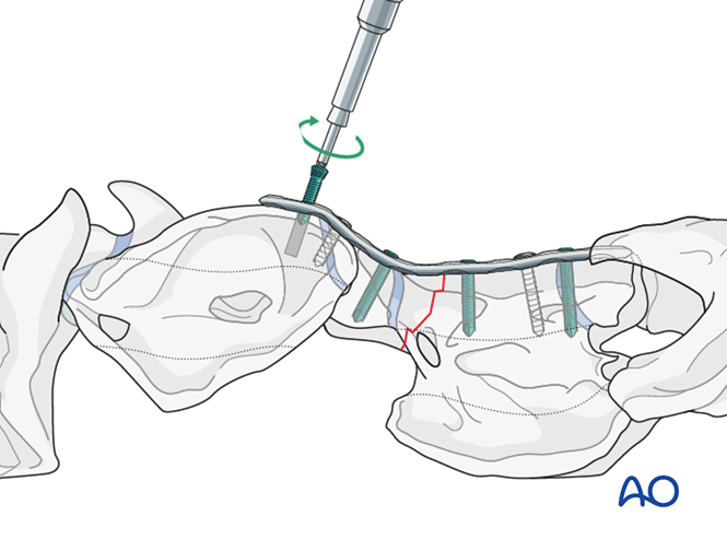 Plate fixation with atlantoaxial arthrodesis for C2 (Axis) dens fractures