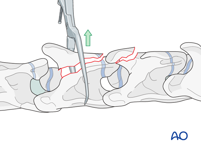 Plate fixation for C3-C7 horizontal body fractures