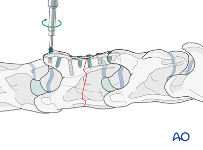 Plate fixation for C3-C7 vertical body fractures