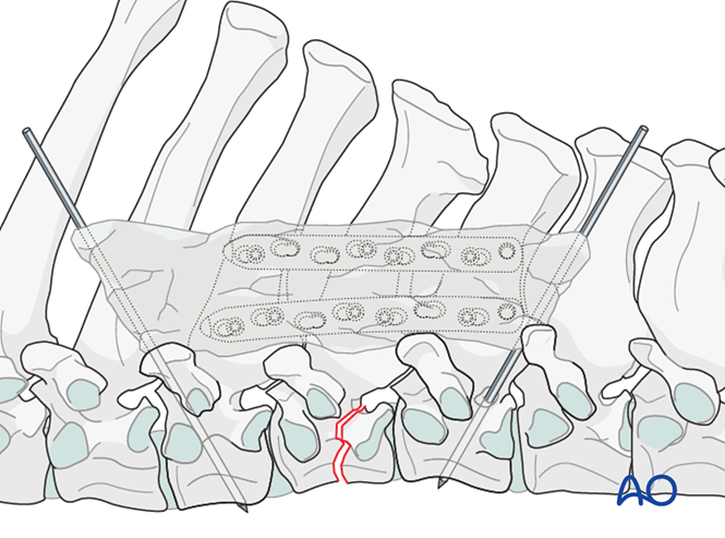 Stabilization for Body fractures of thoracolumbar vertebrae
