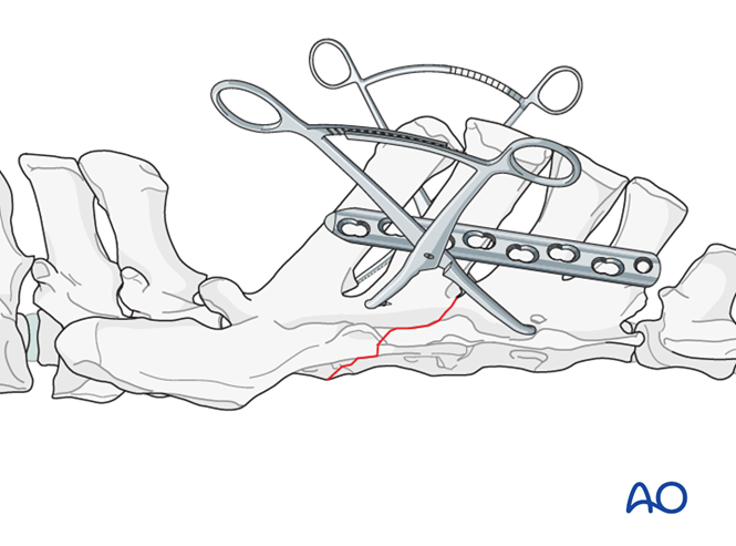 Plate fixation for Sacral fractures