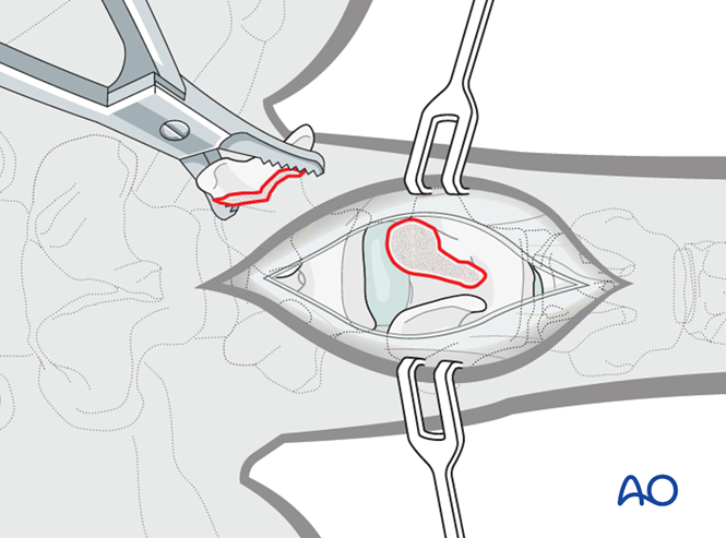 Resection for Coccygeal fractures