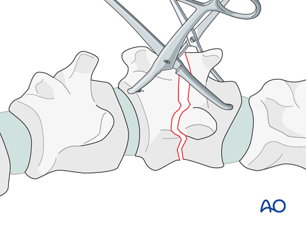 Plate fixation for Coccygeal fractures