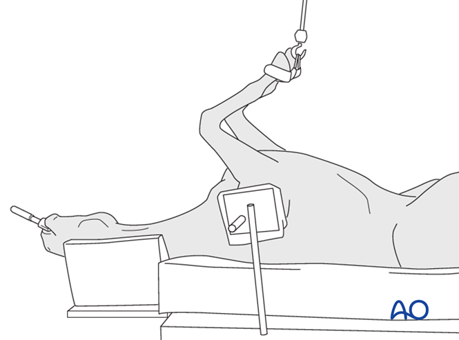Dorsal recumbency