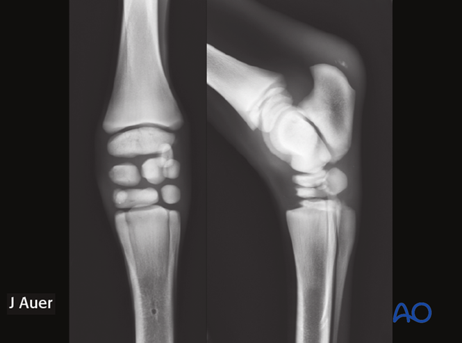 Nonsurgical management for Angular limb deformities
