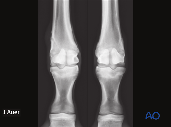 Growth retardation for Angular limb deformities