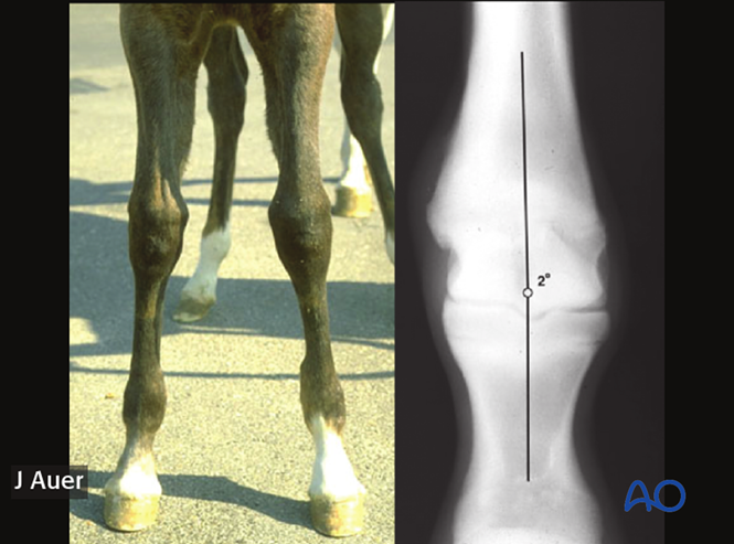 Growth acceleration for Angular limb deformities