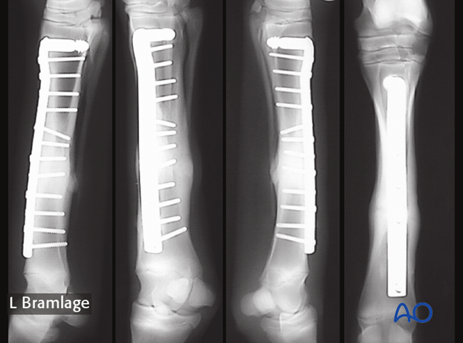 Corrective osteotomies for Angular limb deformities