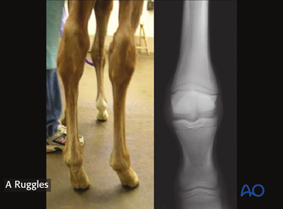 Growth retardation for Angular limb deformities