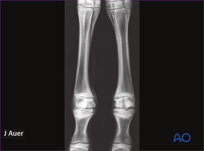 Growth retardation for Angular limb deformities