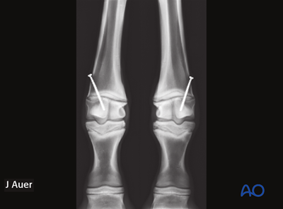 Growth retardation for Angular limb deformities