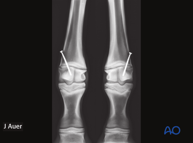 Growth retardation for Angular limb deformities