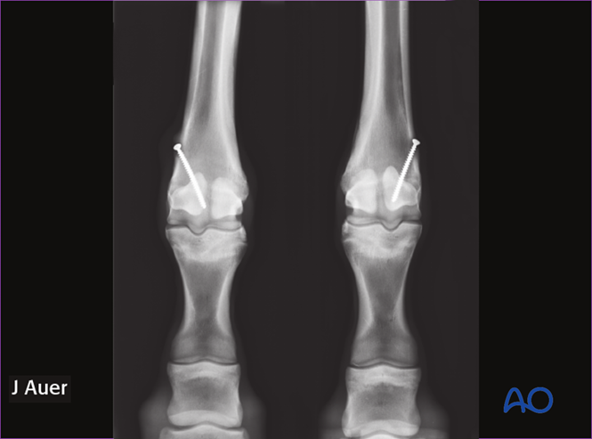 Growth retardation for Angular limb deformities