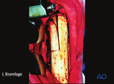 Corrective osteotomy for Angular limb deformities