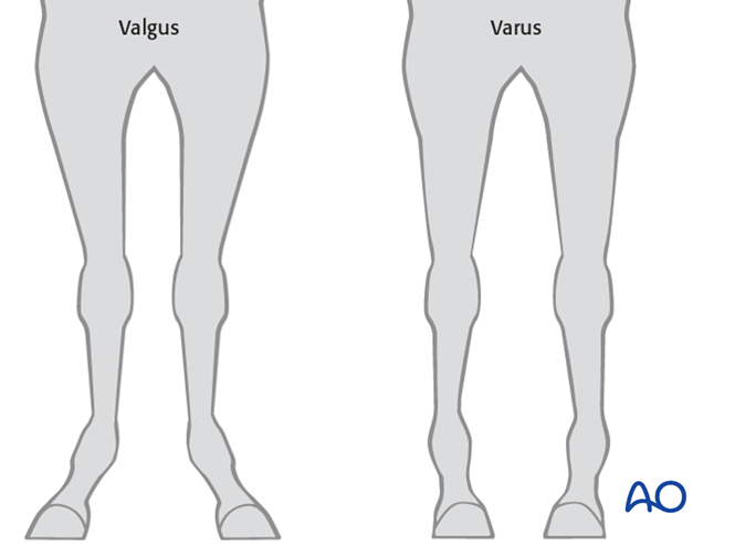 Angular limb deformities