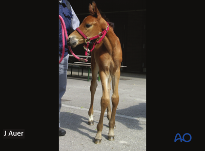 Angular limb deformities