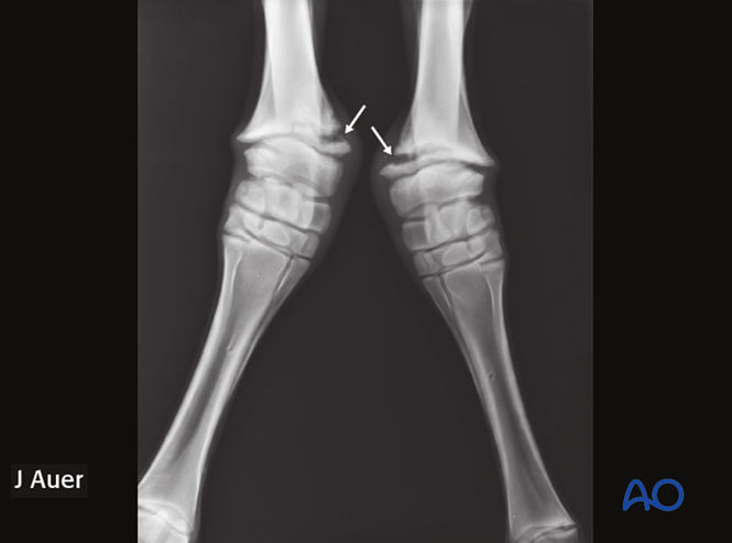 Angular limb deformities