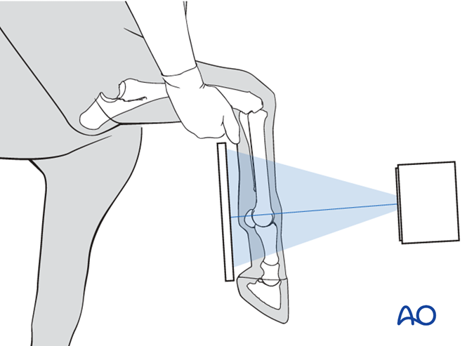 Angular limb deformities