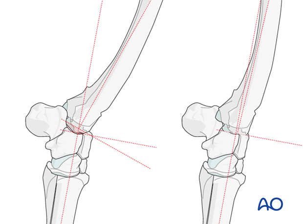 Partial carpal arthrodesis for Distal row fractures
