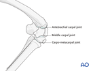 Treatment of Distal row fractures