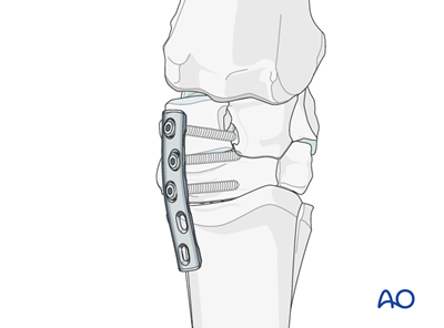 Partial carpal arthrodesis for Distal row fractures