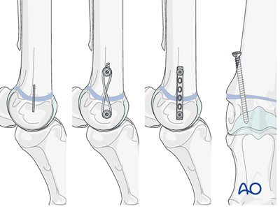 Growth retardation for Angular limb deformities