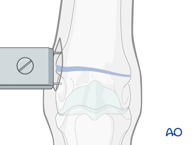 Growth retardation for Angular limb deformities