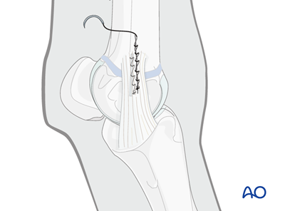 Growth retardation for Angular limb deformities