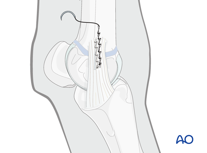 Growth retardation for Angular limb deformities