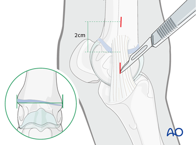 Growth retardation for Angular limb deformities