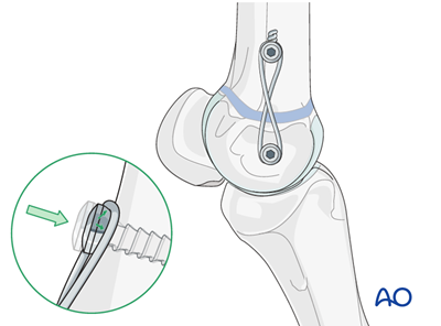 Growth retardation for Angular limb deformities