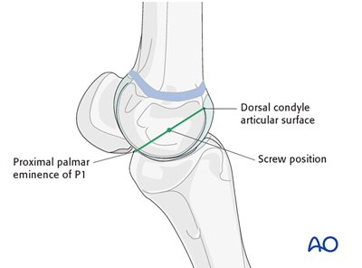 Growth retardation for Angular limb deformities