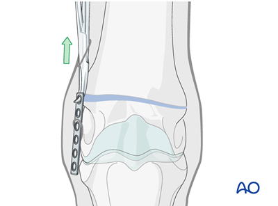 Growth retardation for Angular limb deformities