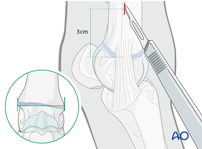 Growth retardation for Angular limb deformities