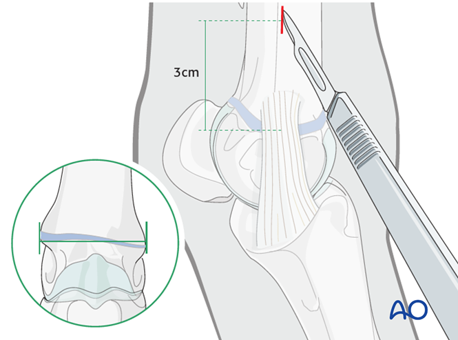 Growth retardation for Angular limb deformities