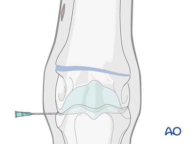 Growth retardation for Angular limb deformities