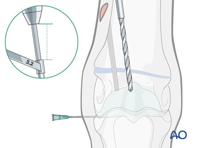 Growth retardation for Angular limb deformities