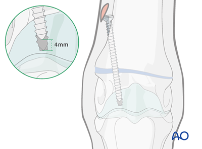 Growth retardation for Angular limb deformities