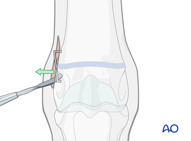 Staple removal