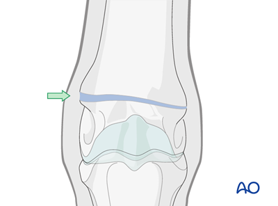 Growth retardation for Angular limb deformities