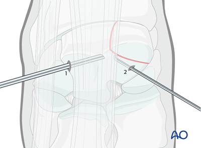 Arthroscopic approach