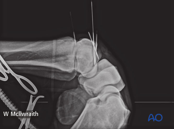 Arthroscopic screw fixation for 3rd carpal bone: Frontal slab fractures ...