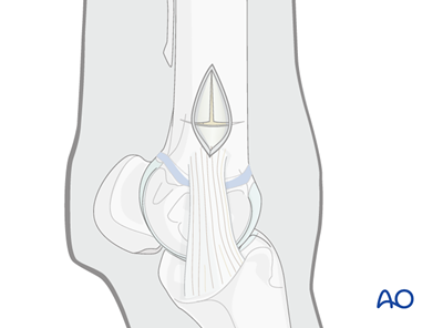 Growth acceleration for Angular limb deformities