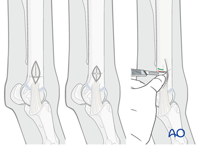 Growth acceleration for Angular limb deformities