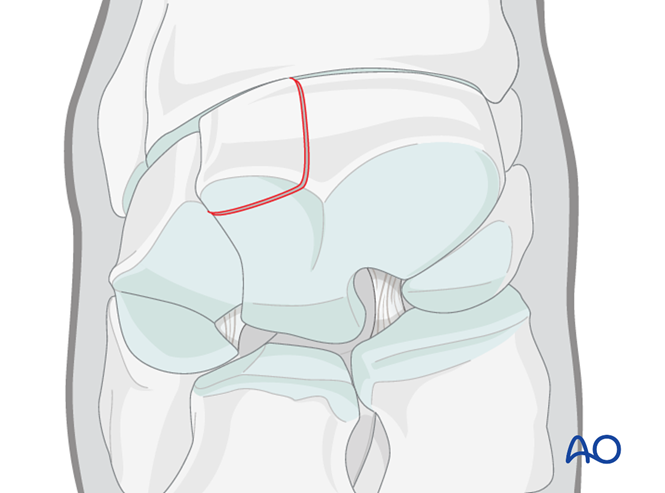 Slab fractures classification