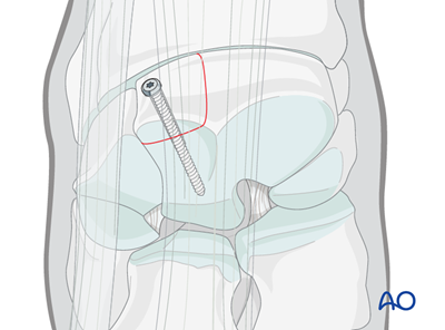 Arthroscopic screw fixation for 3rd carpal bone: Frontal slab fractures ...