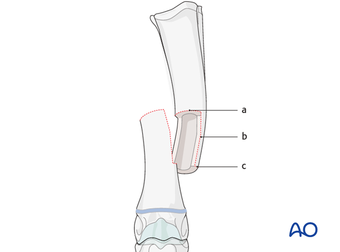 Corrective osteotomies for Angular limb deformities