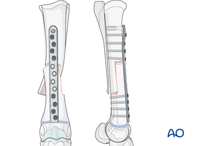 Corrective osteotomies for Angular limb deformities