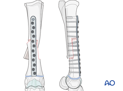 Corrective osteotomies for Angular limb deformities